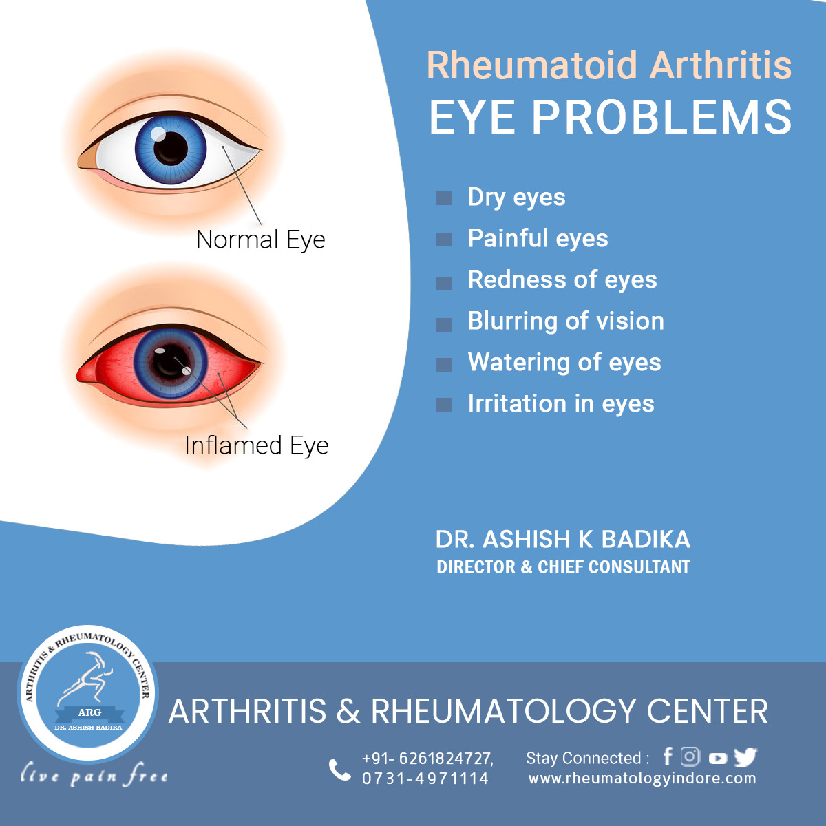 Rheumatoid Arthritis & Eye Problems - Dr. Ashish Badika ...